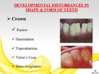 Developmental Anomalies Of Teeth | PPTX