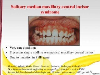 Developmental Anomalies Of Teeth | PPTX