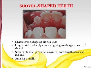 Developmental Anomalies Of Teeth | PPTX