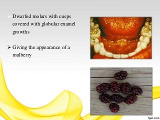 Developmental Anomalies Of Teeth | PPTX