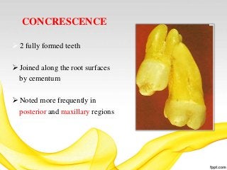Developmental Anomalies Of Teeth | PPTX