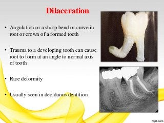 Developmental Anomalies Of Teeth | PPTX