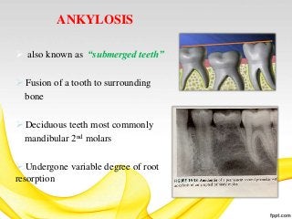 Developmental Anomalies Of Teeth | PPTX