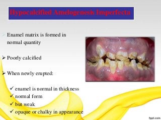 Developmental Anomalies Of Teeth | PPTX