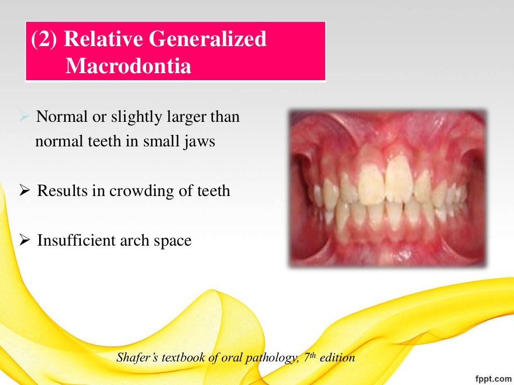 Developmental Anomalies Of Teeth | PPTX