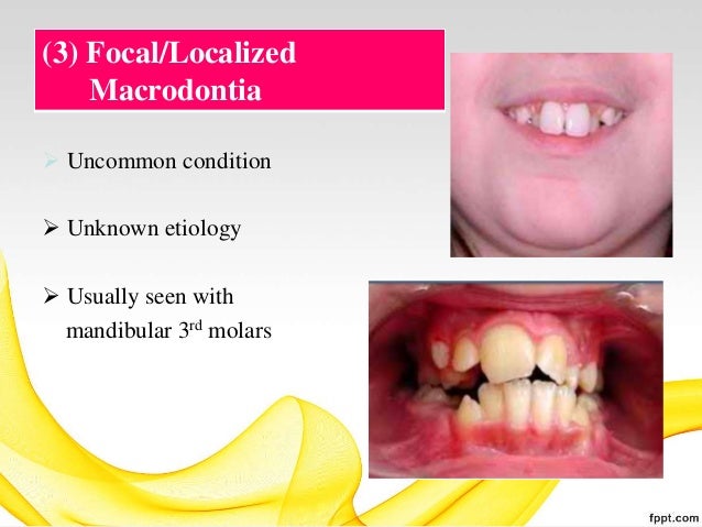 Developmental Anomalies Of Teeth | PPTX