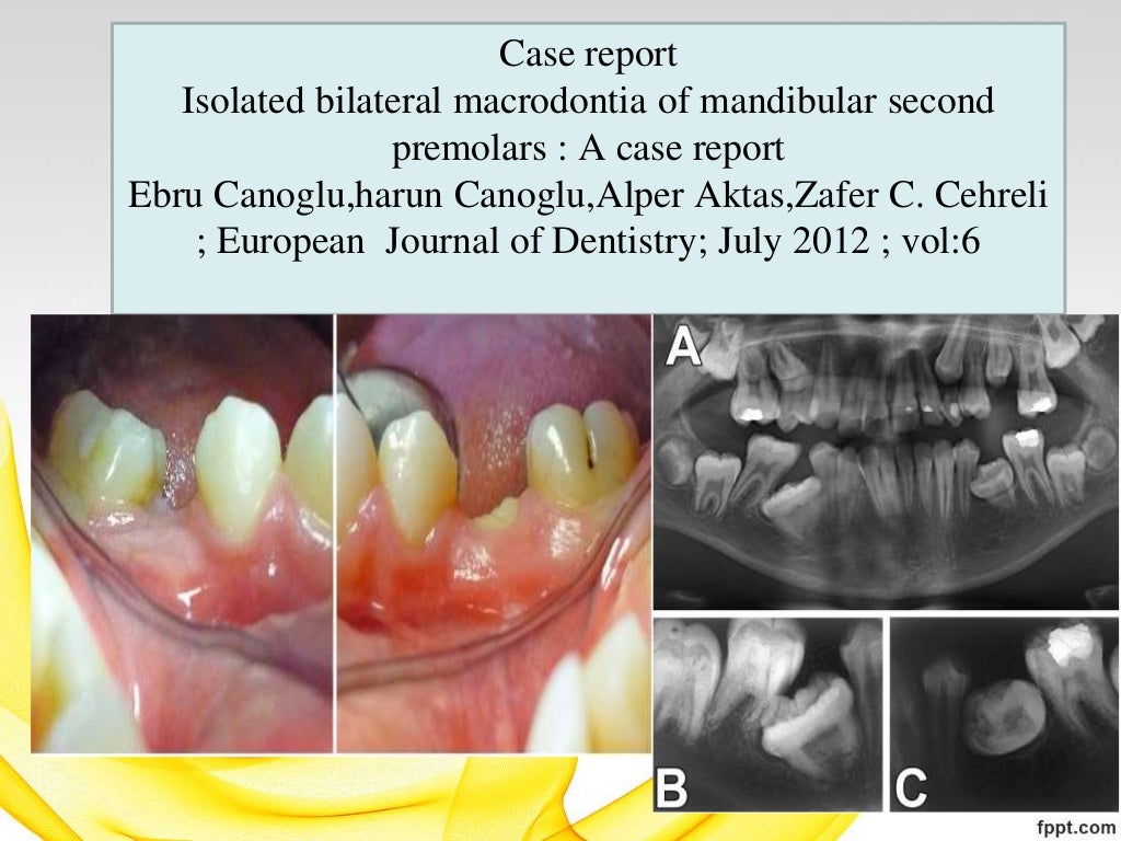Developmental Anomalies Of Teeth | PPTX