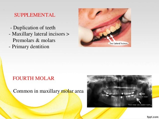 Developmental Anomalies Of Teeth | PPTX