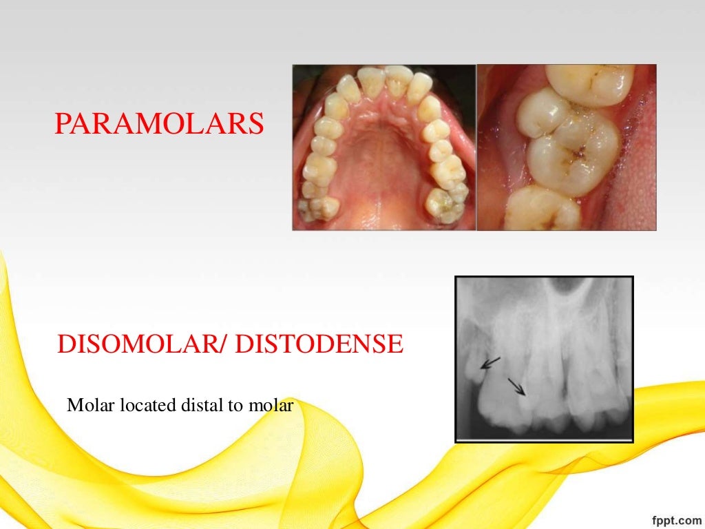 Developmental Anomalies Of Teeth | PPTX