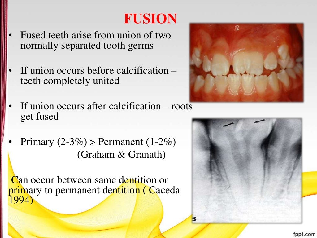 Developmental Anomalies Of Teeth | PPTX