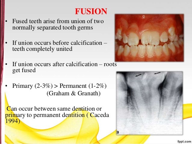 Developmental Anomalies Of Teeth | PPTX