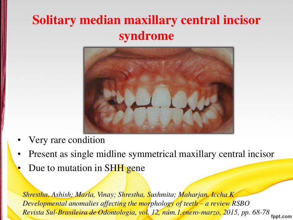 Developmental Anomalies Of Teeth | PPTX