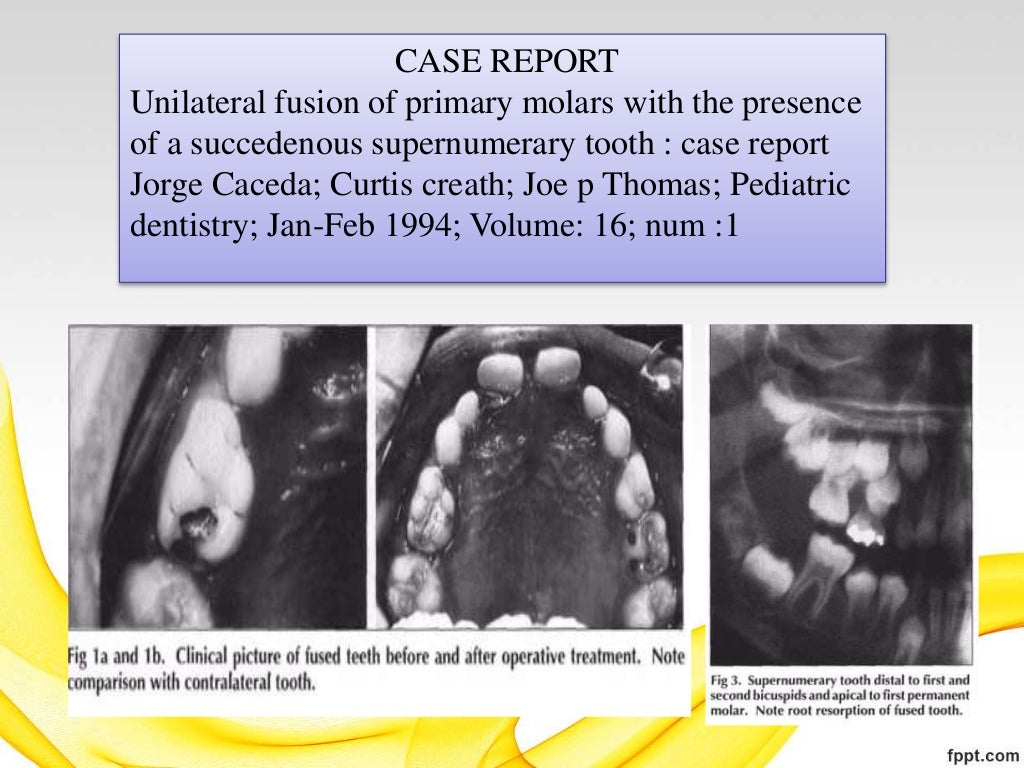 Developmental Anomalies Of Teeth | PPTX