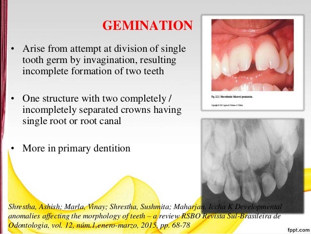 Developmental Anomalies Of Teeth | PPTX