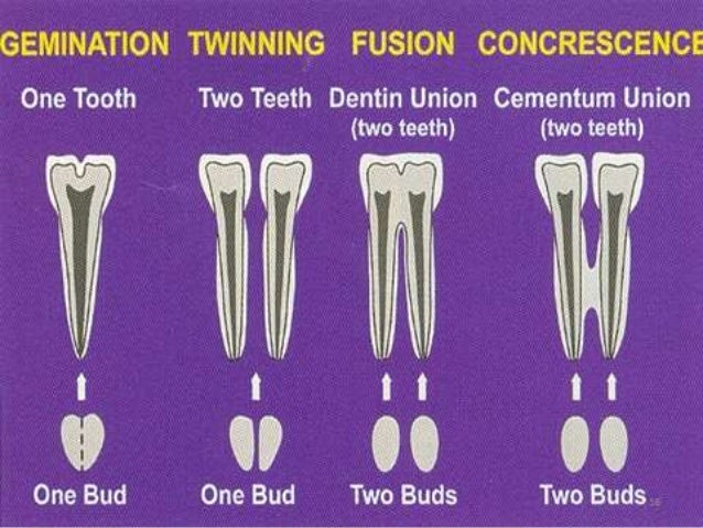 Developmental Anomalies Of Teeth | PPTX