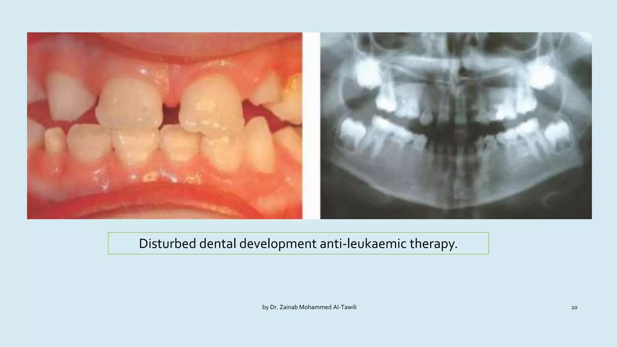 Anomalies of tooth formation and eruption | PPTX