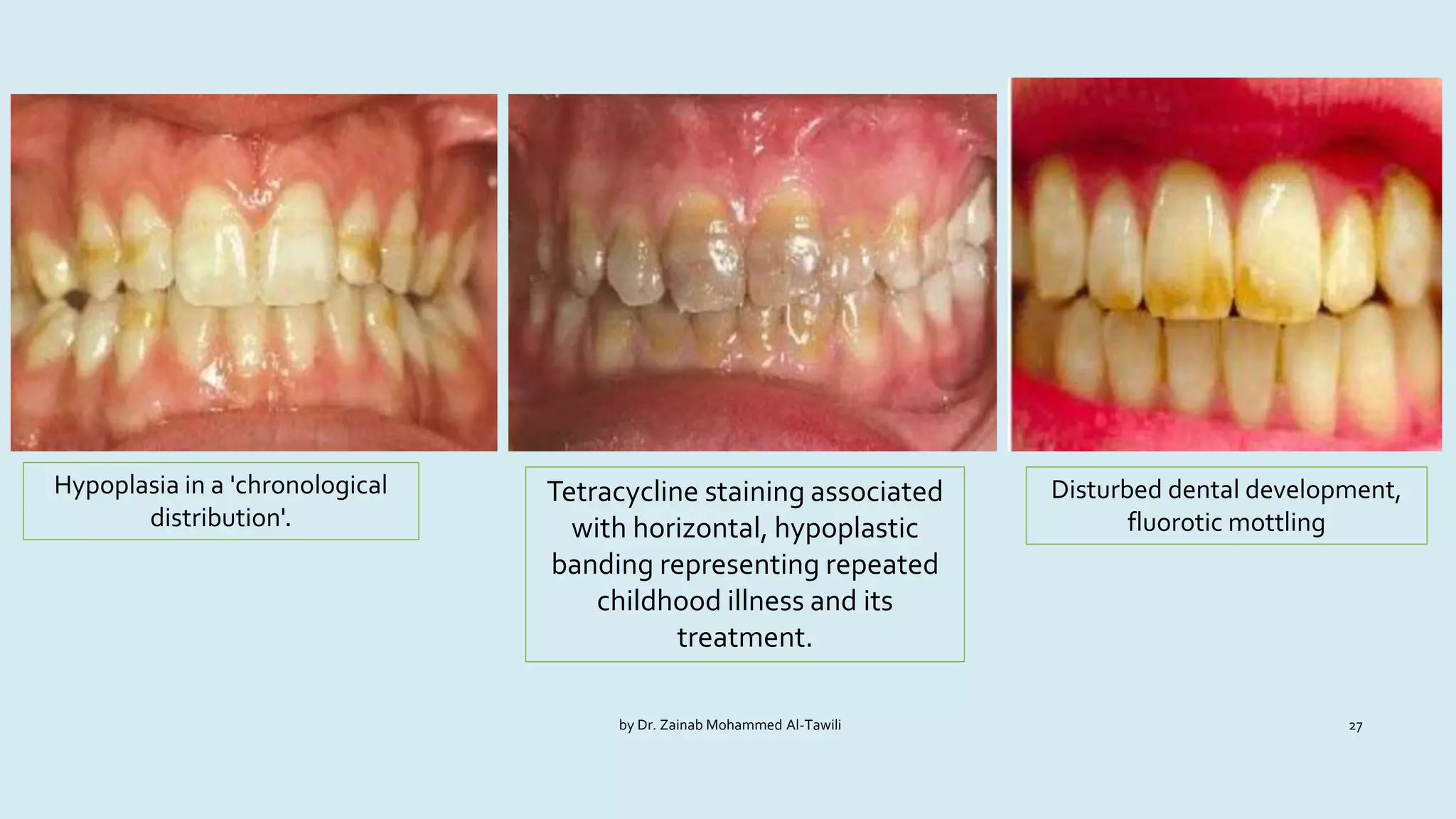 Anomalies of tooth formation and eruption | PPTX