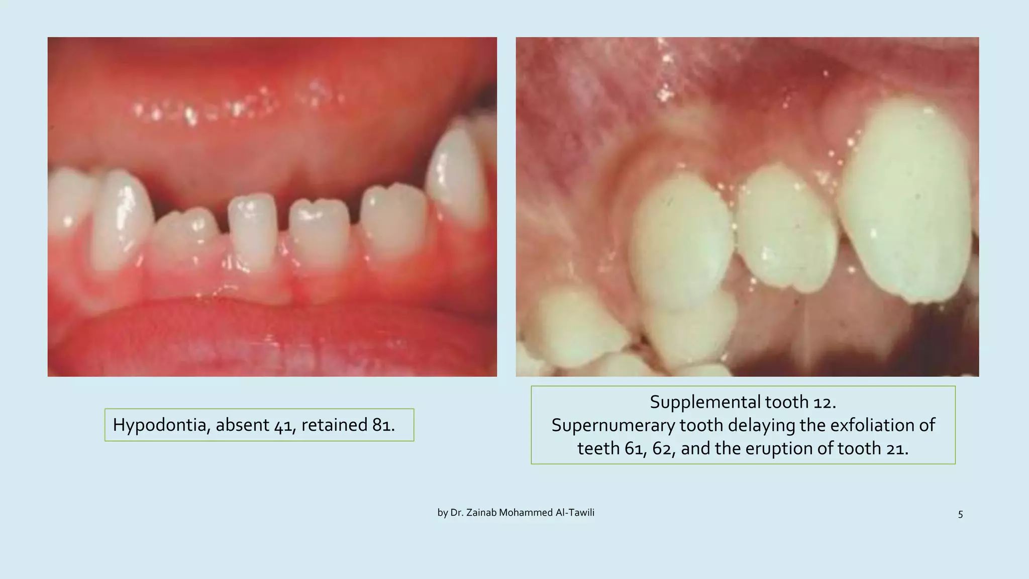 Anomalies of tooth formation and eruption | PPTX