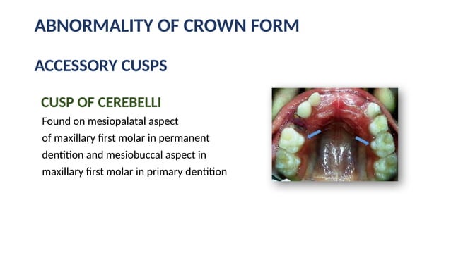 ANOMALIES OF TOOTH FORMATION AND ERUPTION..pptx