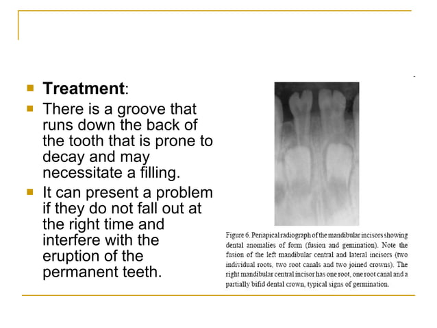 Anomalies of tooth formation & eruption | PPT