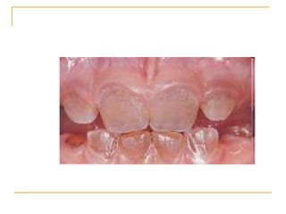 Anomalies of tooth formation & eruption | PPT
