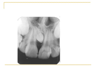 Anomalies of tooth formation & eruption | PPT