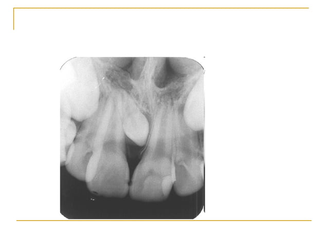 Anomalies of tooth formation & eruption | PPT