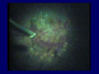 ANOMALOUS PVD IN THE PATHOGENESIS OF VITREO-RETINAL DISEASES | PPT