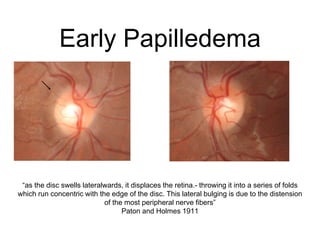 Papilledema Vs Normal
