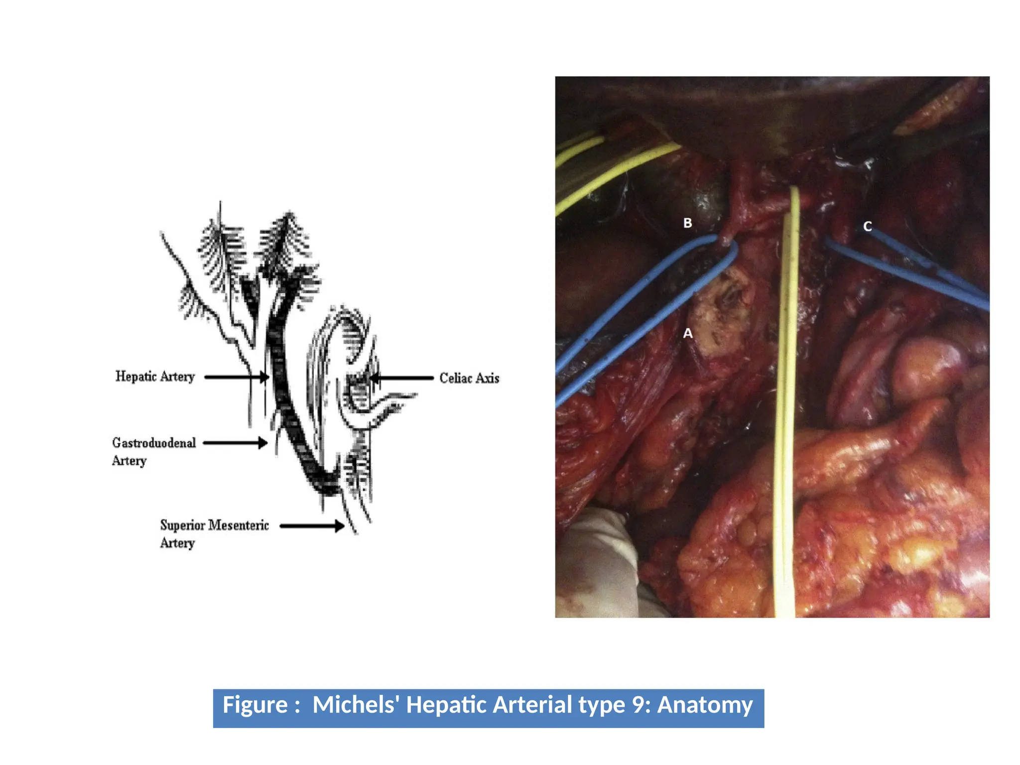 Anomalous hepatic artery artery in Whipple.pptx