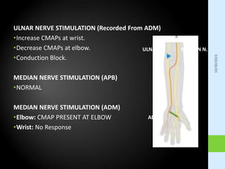 Anomalous Innervation.ppt