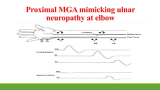 Anomalous innervations | PPTX
