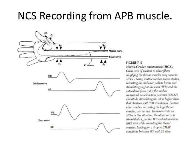 Anomalous Innervations in (EMG/NCS) by Murtaza