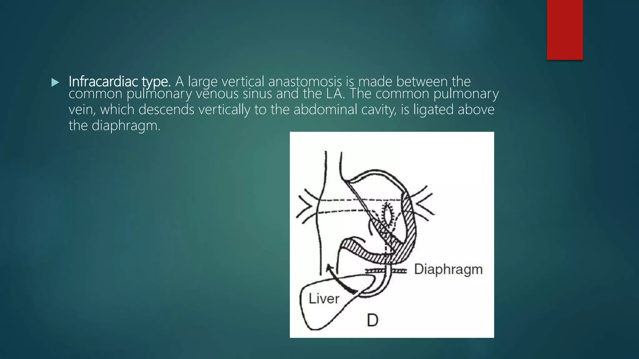 Anomalous pulmonary venous drainage total & partial CT role | PPTX