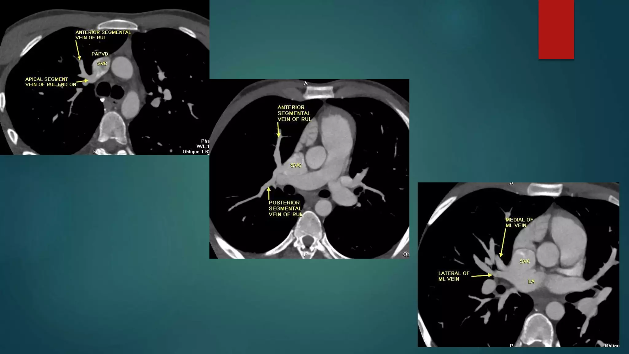 Anomalous pulmonary venous drainage total & partial CT role | PPTX