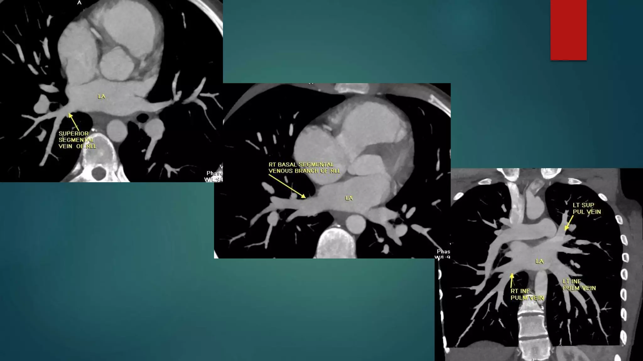 Anomalous pulmonary venous drainage total & partial CT role | PPTX