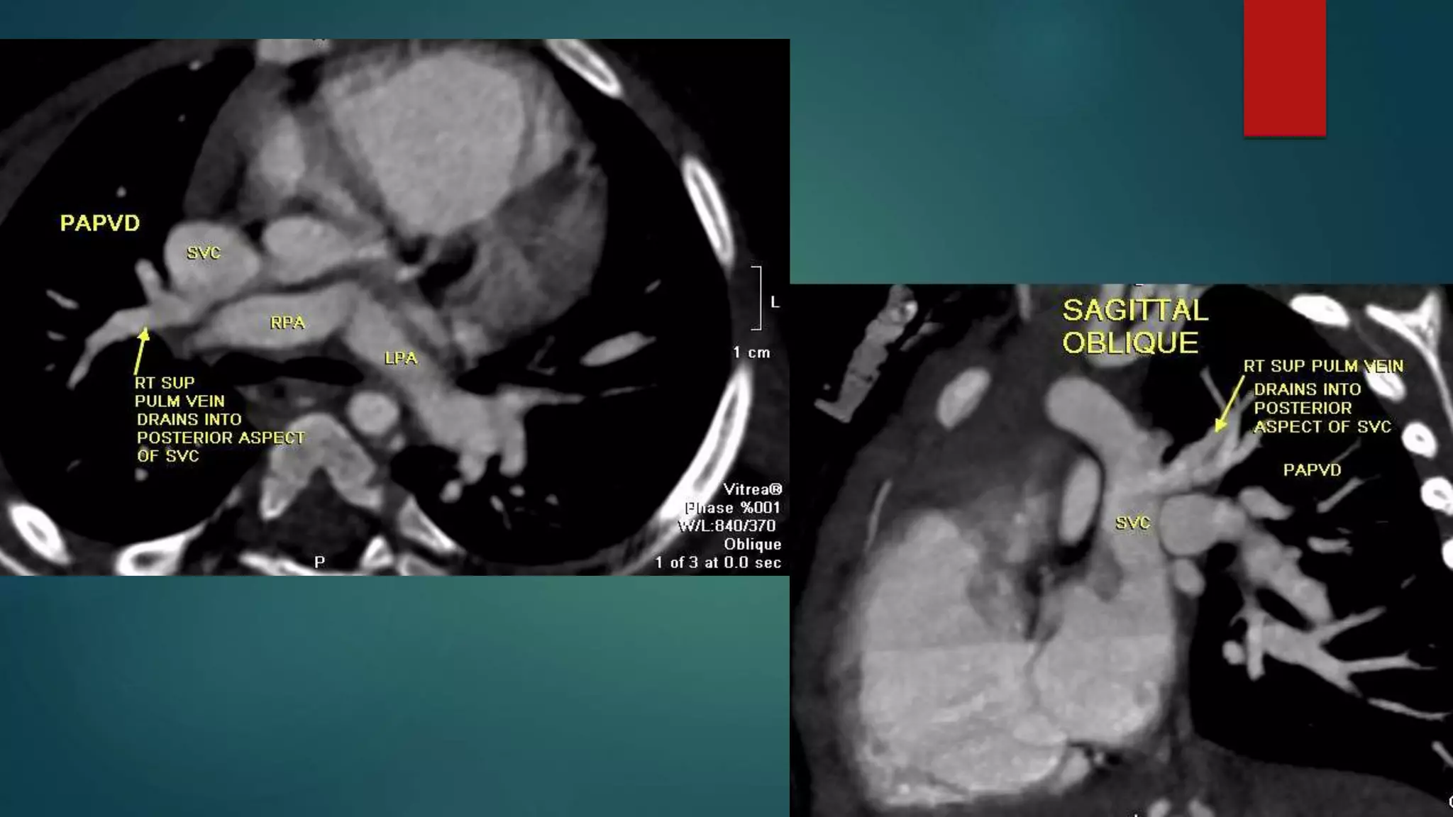 Anomalous pulmonary venous drainage total & partial CT role | PPTX