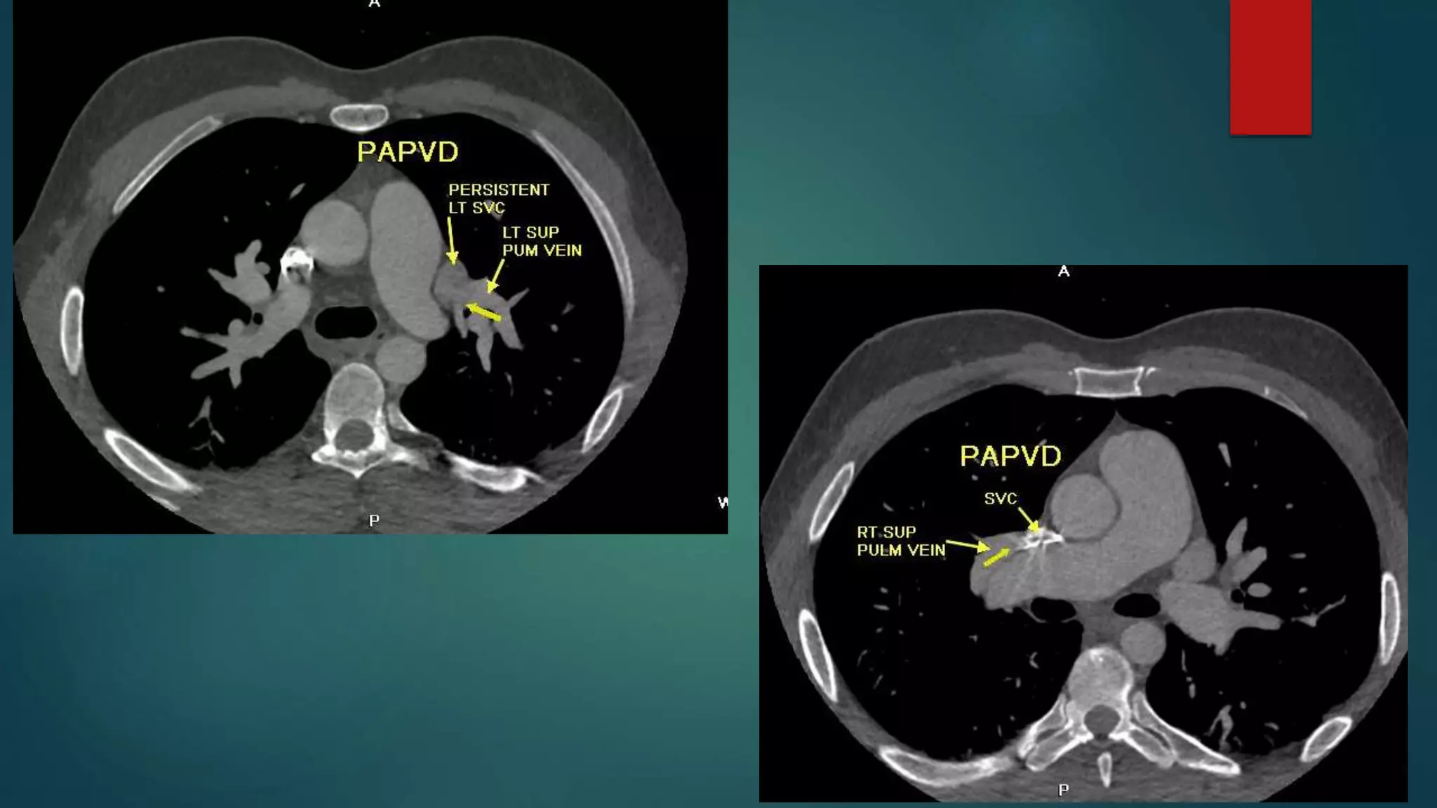 Anomalous pulmonary venous drainage total & partial CT role | PPTX