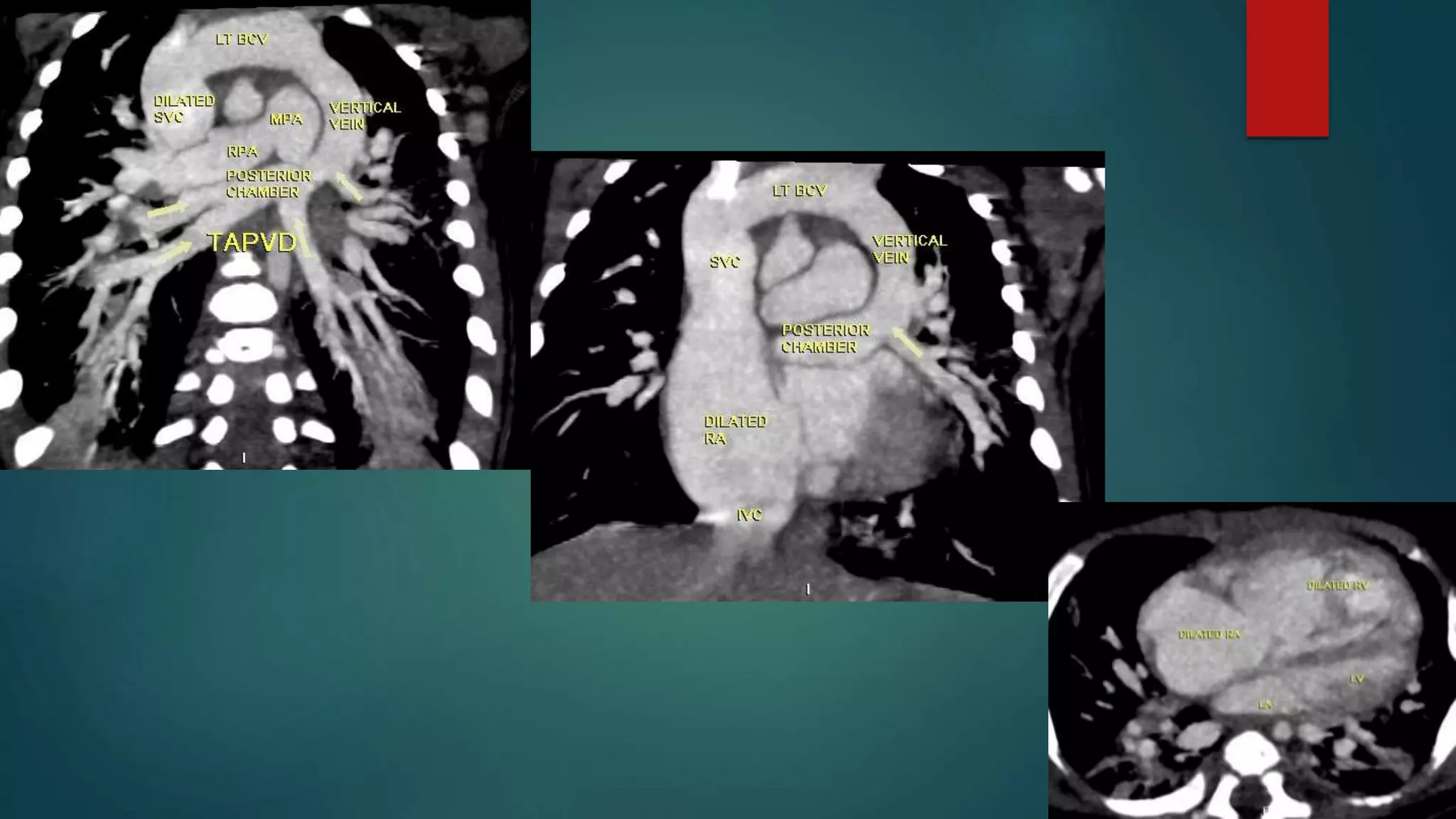 Anomalous pulmonary venous drainage total & partial CT role | PPTX