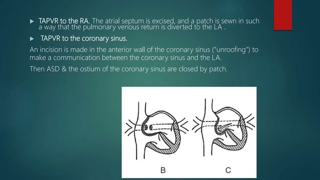 Anomalous pulmonary venous drainage total & partial CT role | PPTX