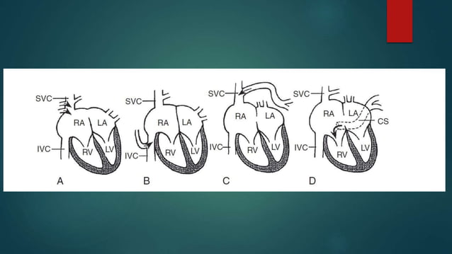 Anomalous pulmonary venous drainage total & partial CT role | PPTX