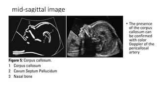 anomaly scan. fetal anomaly scan. second trimester scan | PPTX
