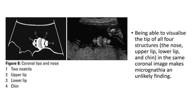 anomaly scan. fetal anomaly scan. second trimester scan | PPTX ...