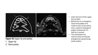 anomaly scan. fetal anomaly scan. second trimester scan | PPTX