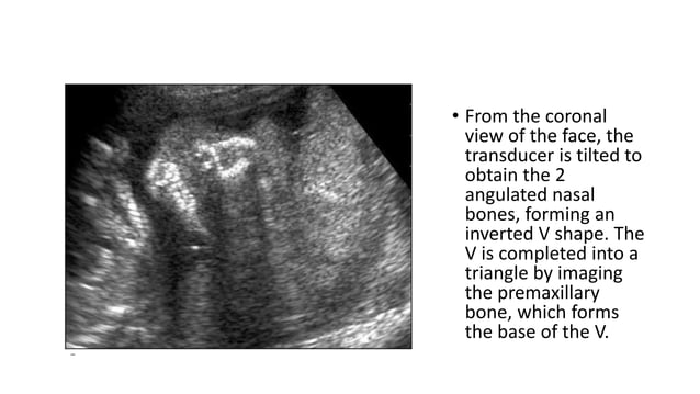 anomaly scan. fetal anomaly scan. second trimester scan | PPTX ...