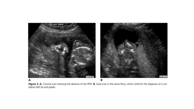 anomaly scan. fetal anomaly scan. second trimester scan | PPTX ...