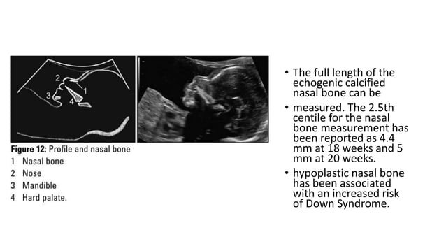 anomaly scan. fetal anomaly scan. second trimester scan | PPTX ...