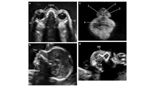 anomaly scan. fetal anomaly scan. second trimester scan | PPTX ...