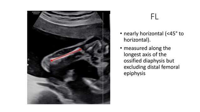 anomaly scan. fetal anomaly scan. second trimester scan | PPTX ...