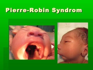 Anomalies of oral & para oral region | PPT